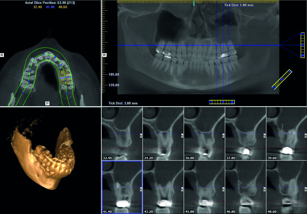 Dental News - Maxillary sinus and root canal therapy complications