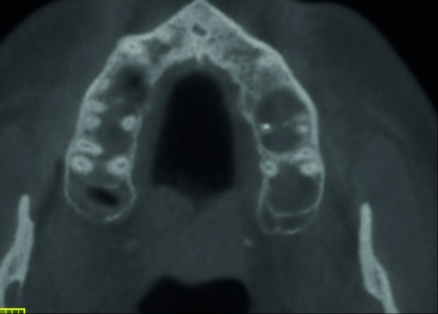 Dental News - Maxillary sinus and root canal therapy complications