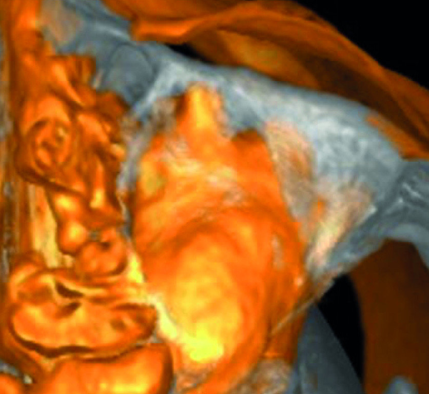 Dental News - Maxillary sinus and root canal therapy complications