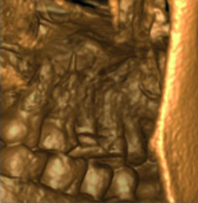 Dental News - Maxillary sinus and root canal therapy complications