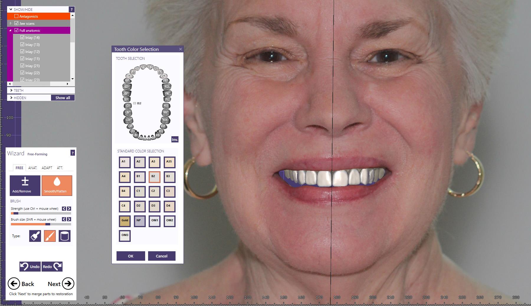 Digital face-bow transfer technique dentofacial analyser for dental ...