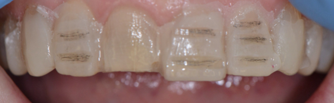 Digital face-bow transfer technique dentofacial analyser for dental ...