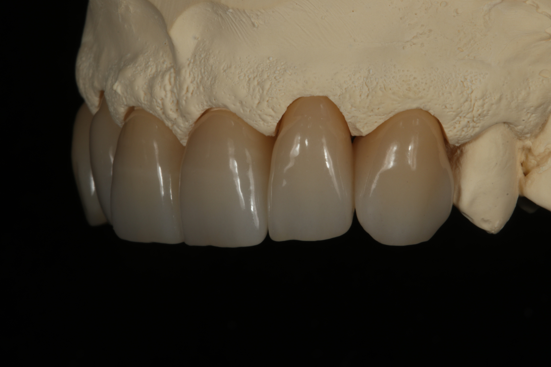 The zirconia dream team: Effect liquids and micro-layering
